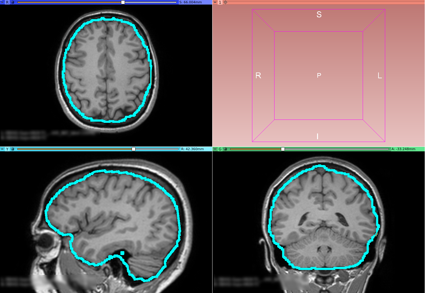 SlicerBrainVolumeRefinement